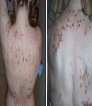 Morgellons Disease Exploration